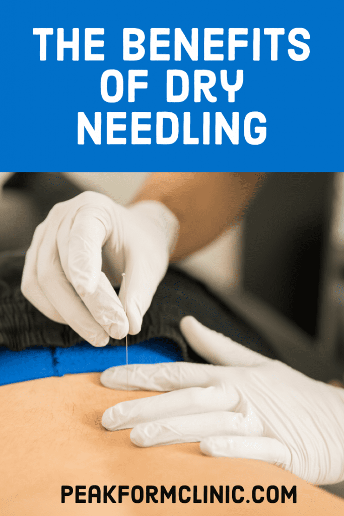 The Benefits of Dry Needling